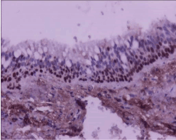 Neurenteric cyst of the 4th ventricle. Case report and short review of ...
