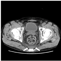 Abnormal density area in the presacral region of patients with fever of ...