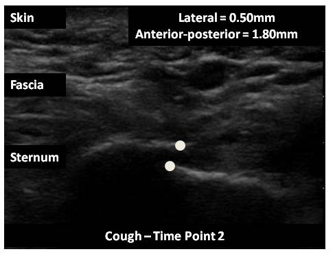 Real-time ultrasound assessment of sternal stability in adhesive ...