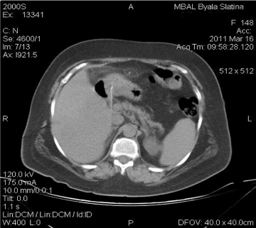 Case report of laparoscopic treatment of biliary peritonitis due to ...