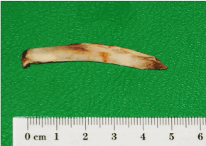 Case report of laparoscopic treatment of biliary peritonitis due to ...