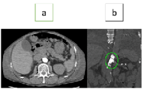 A case of endovascular treatment for juxtarenal aortic calcified ...