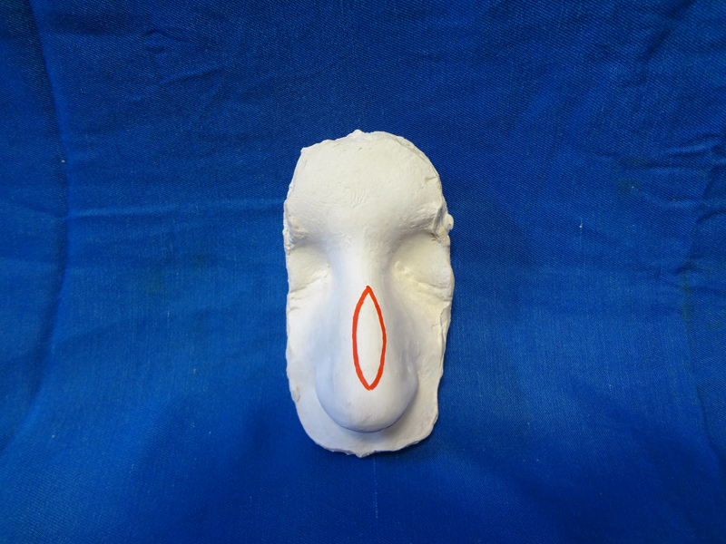 How to remove nose skin excess?. Aesthetically reasonable approach