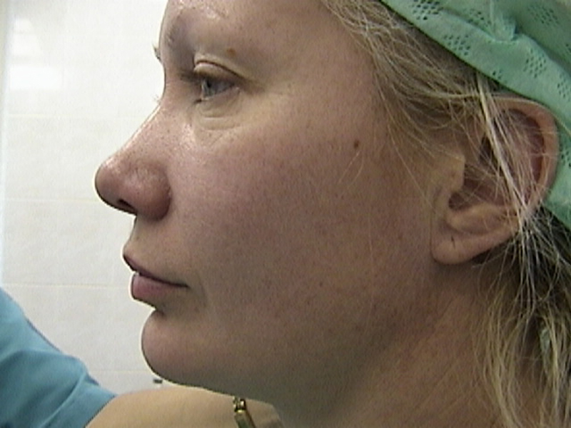 How to remove nose skin excess?. Aesthetically reasonable approach