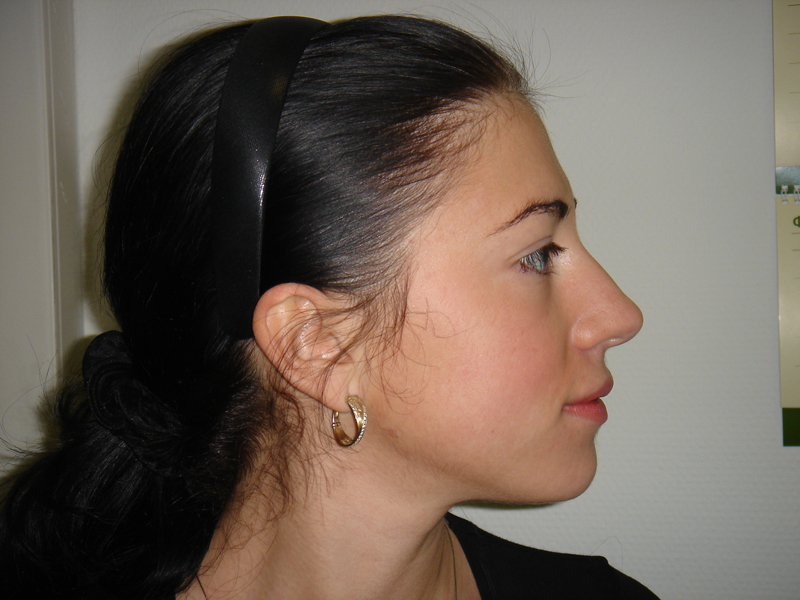 How to remove nose skin excess?. Aesthetically reasonable approach