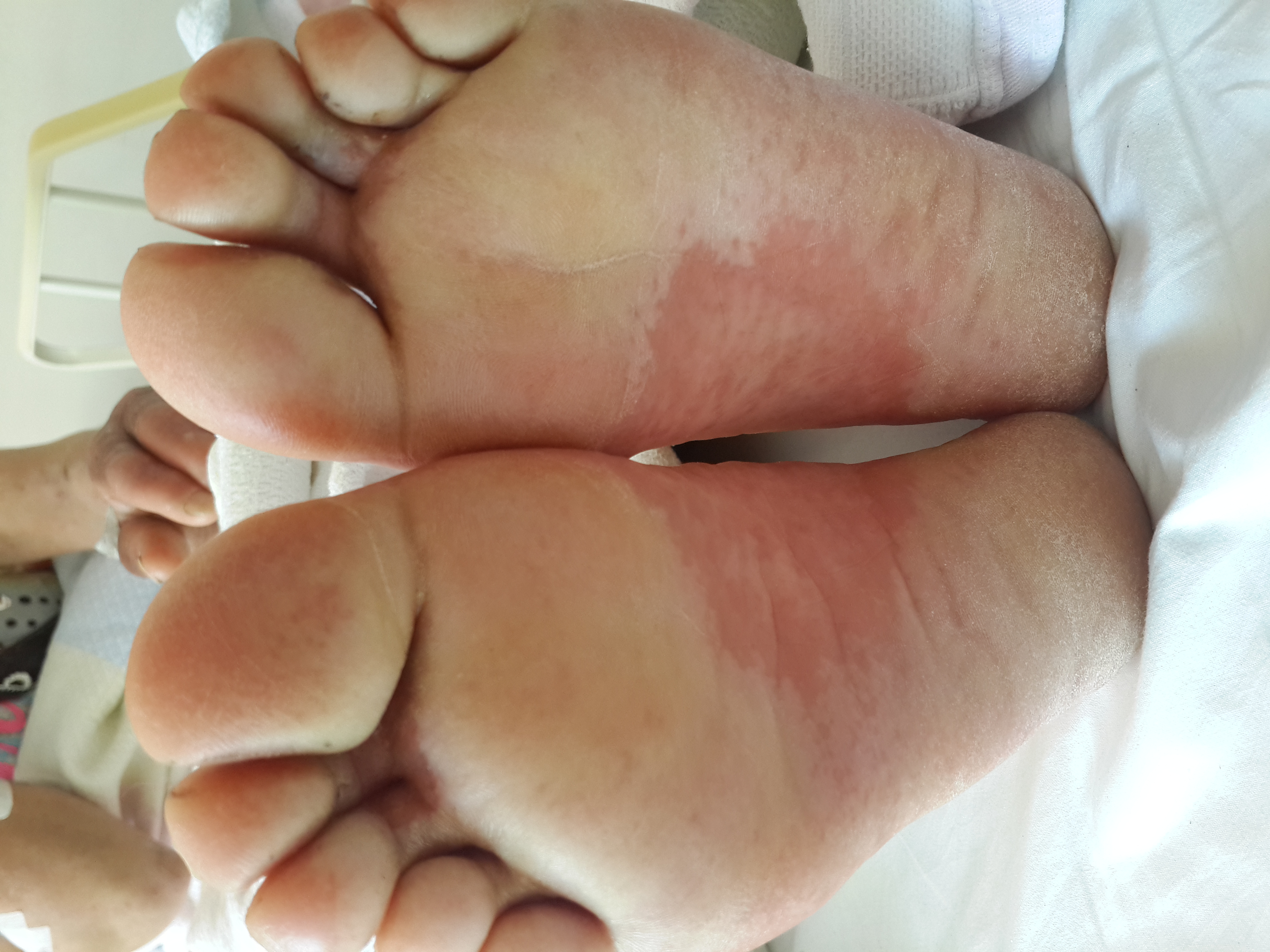 Erythema Multiforme Minor Hand